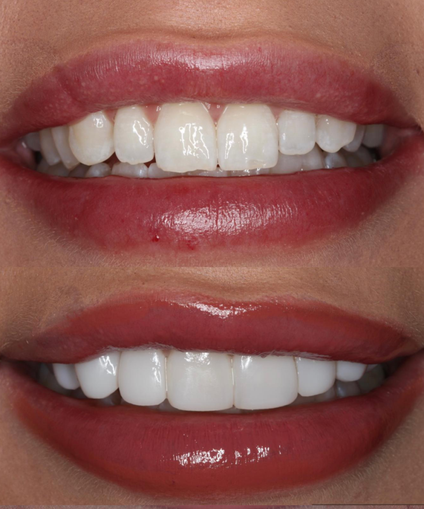 Composite Bonding - Love the Dentist